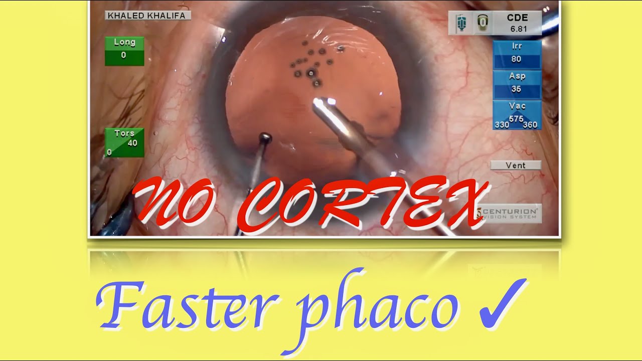 The new phaco technique for 2022 ( cortex free phaco ) - YouTube