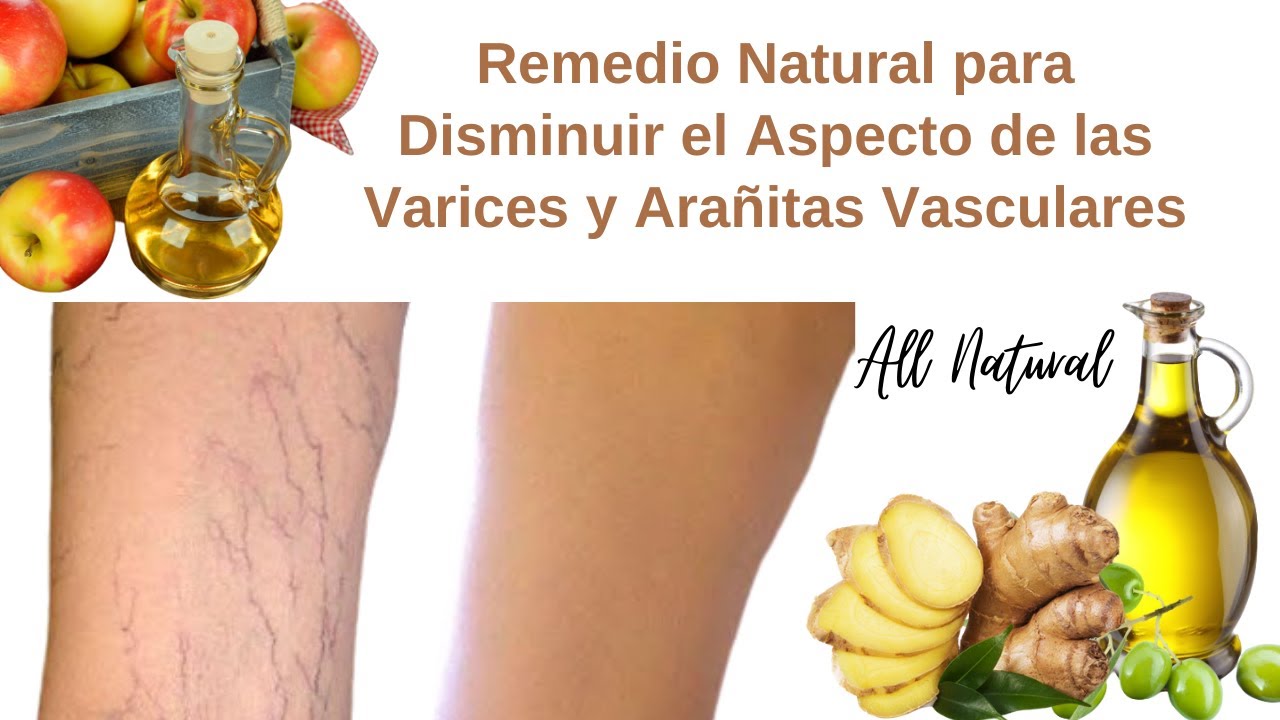 Remedio Natural para Tratar las Varices - YouTube