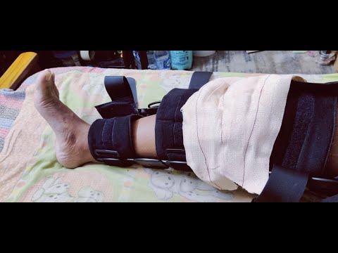 ACL Surgery Stitches Look After Surgery | Total 8 Operation Stitches ...