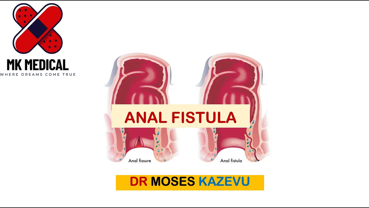 Anal Fistula - YouTube