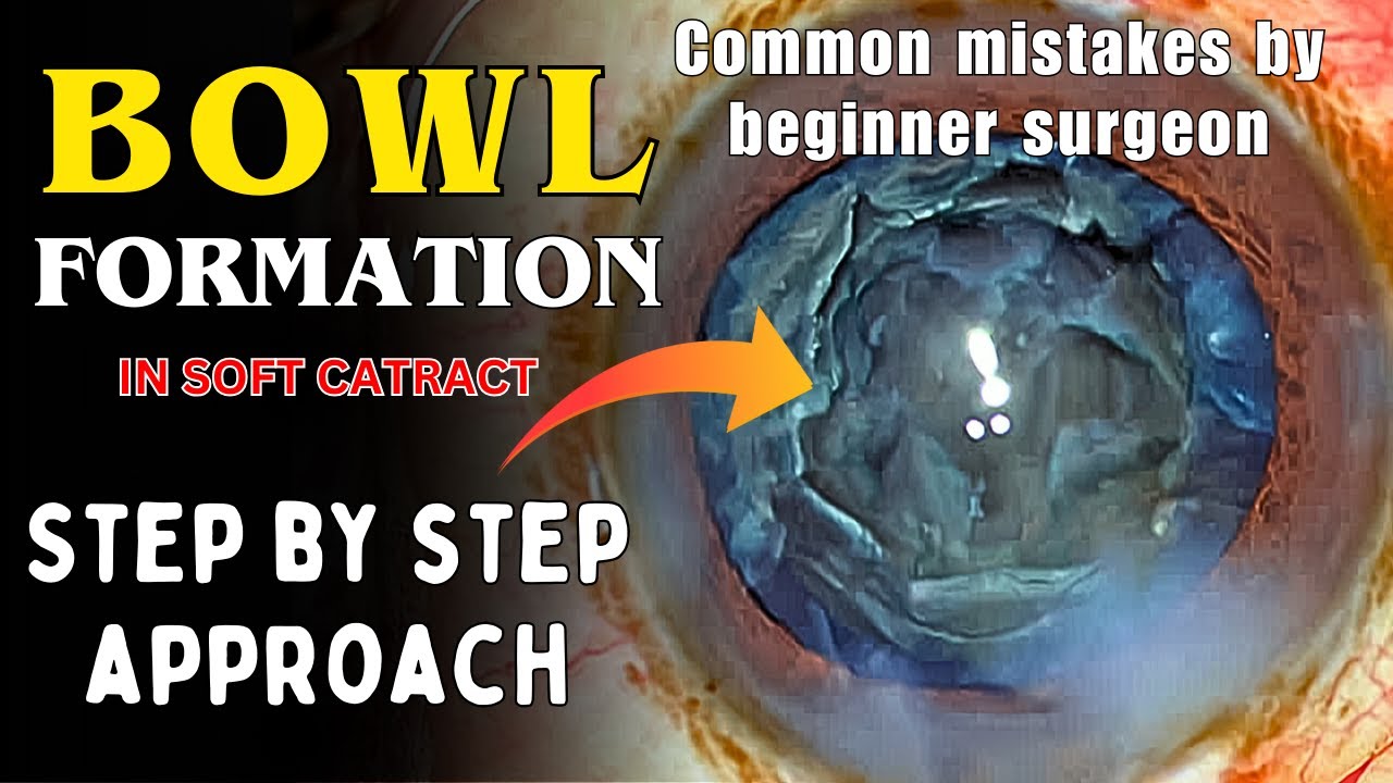 Bowl formation in a soft cataract, Step by step approach Common ...