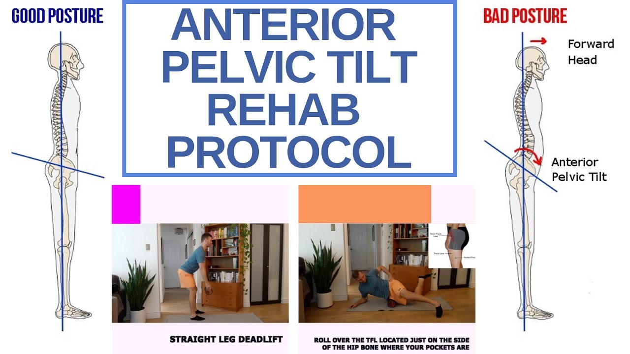 Fix Anterior Pelvic Tilt Anterior Pelvic Tilt Rehab Program Youtube