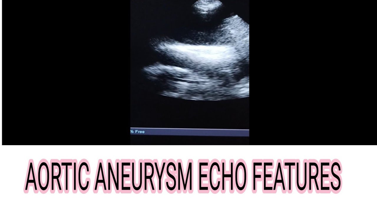 Echocardiographic Features Of Aortic Aneurysm | Diseases Of The Aorta ...