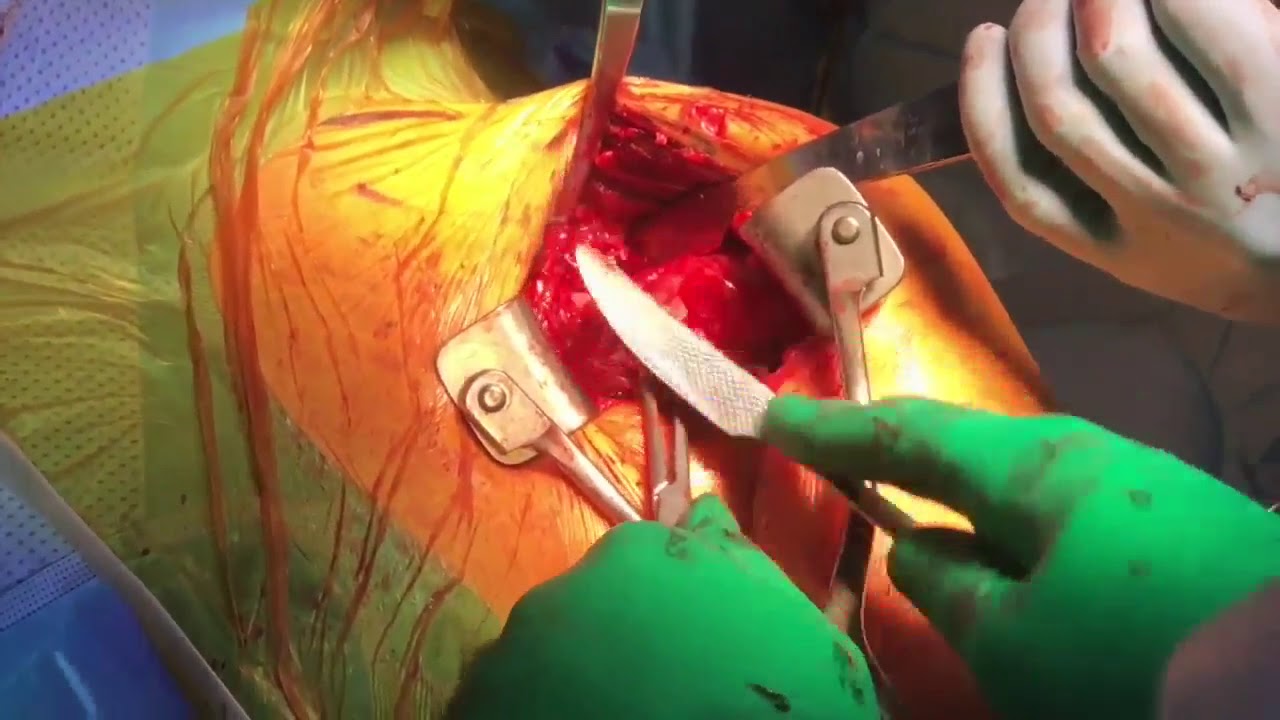 Repair of an Isolated Coracoid Fracture With Suture Anchor Fixation ...