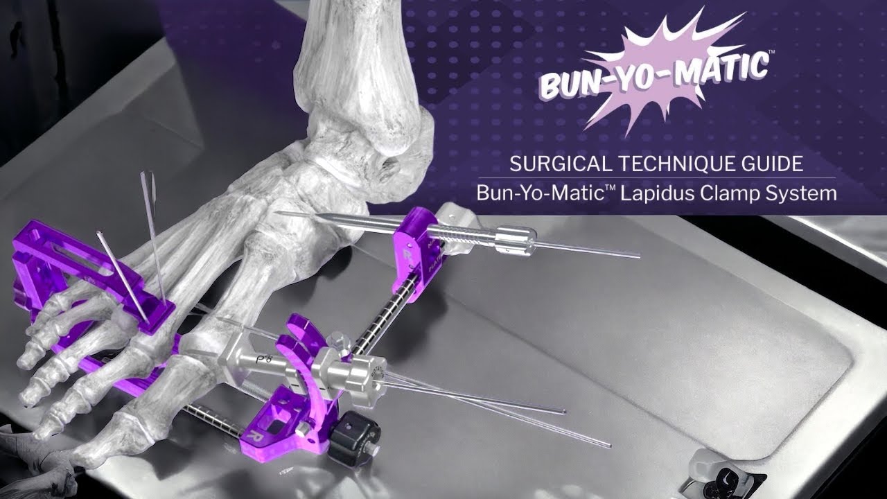 Paragon28 Bun-Yo-Matic Lapidus Clamp System used with Gorilla Lapidus ...