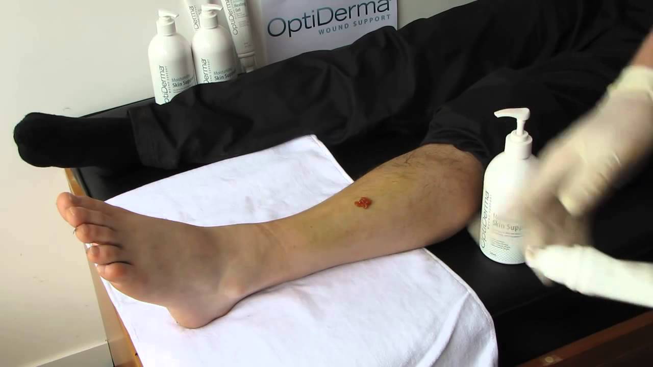 OptiDerma - Applying Activated Healing Gel to Wound - YouTube