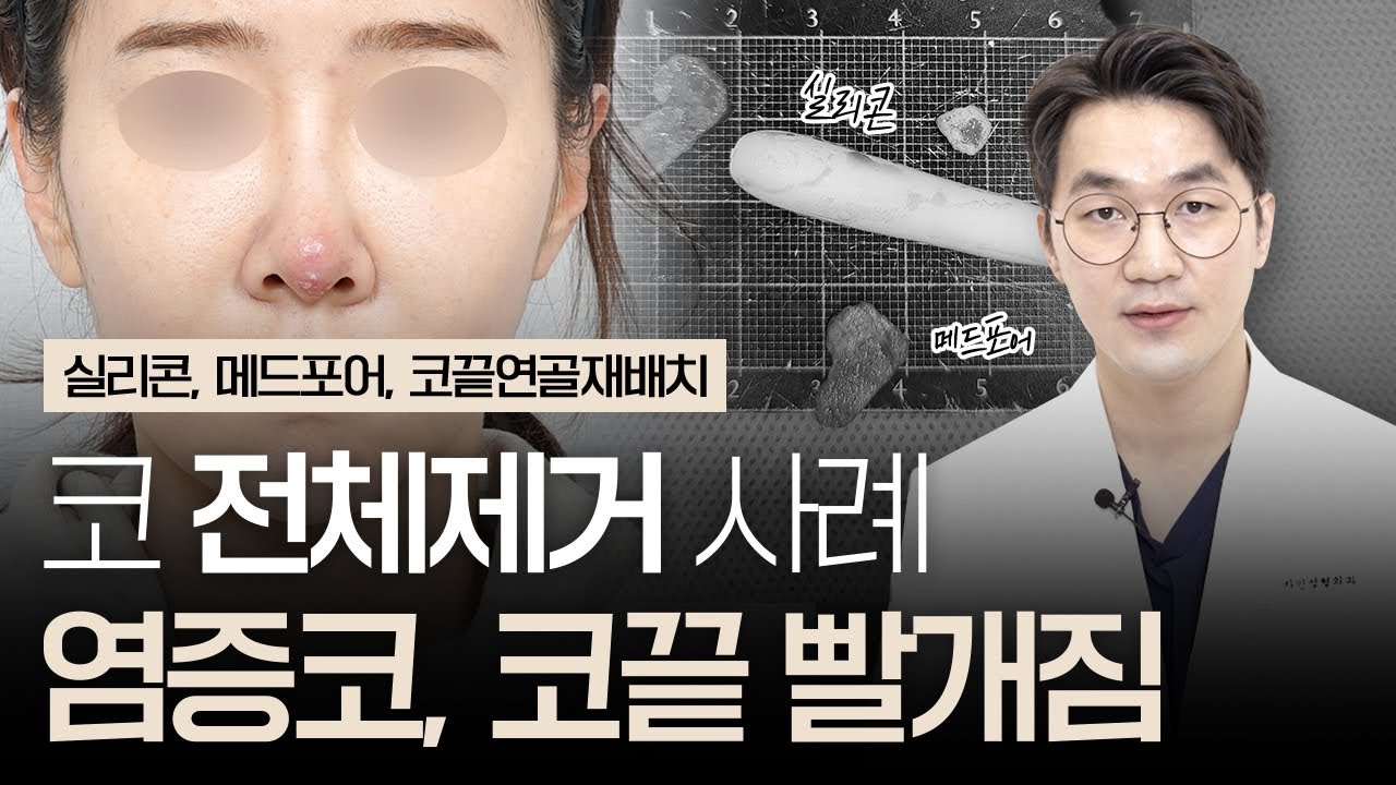 코 보형물 제거 코수술 후 염증 코끝 빨개짐 붓기로 전체제거한 케이스|👃실리콘 메드포어 코끝연골재배치 앞볼필러 제거