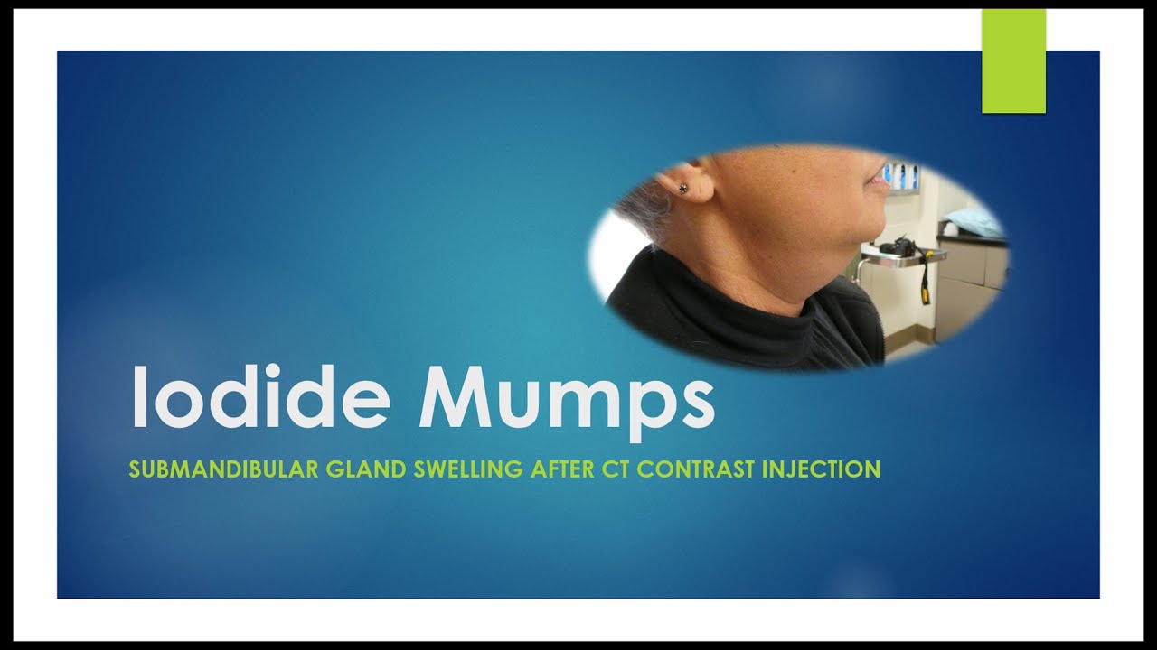 Iodide Mumps - YouTube