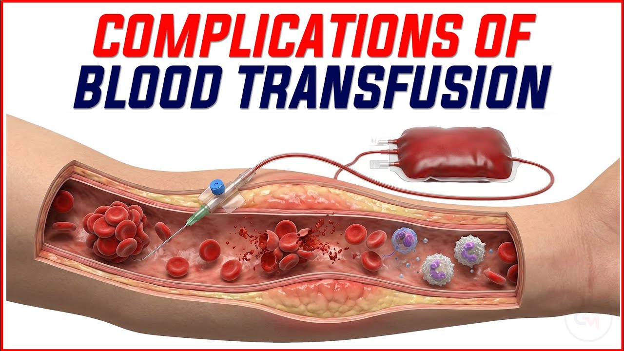 6. Complications of Blood Transfusion 🩸⚡ | Acute & Delayed Reactions ...