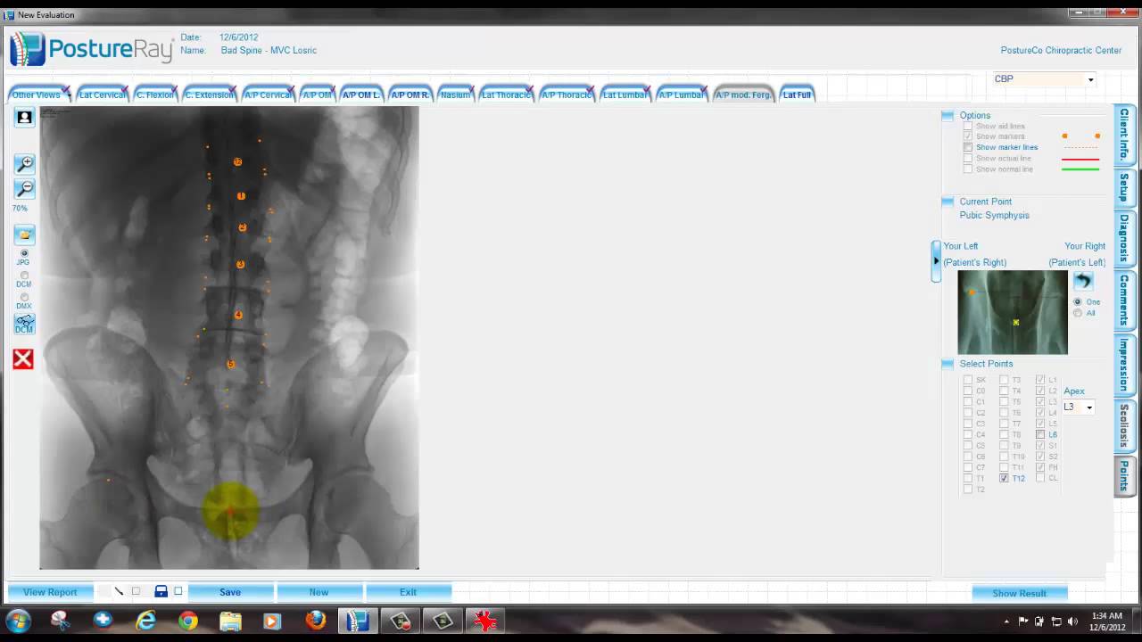 Ferguson View Of Lumbar Spine