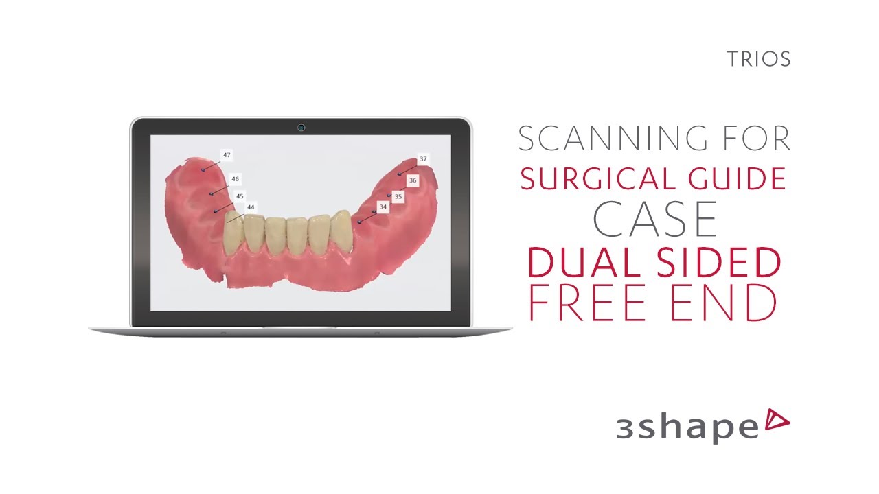 3Shape TRIOS Scanning for surgical guide - Dual Sided Free End Case ...