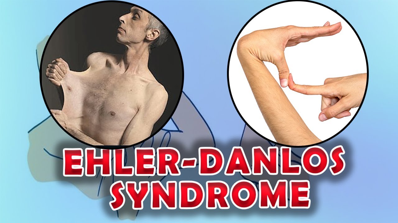 Elher Danlos Syndrome - flexible joints and stretchy, fragile skin ...