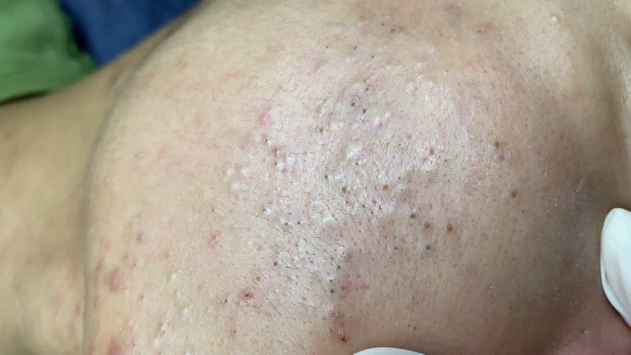 Deep Blackheads Removal from Cheeks and Nose by Na Na 24h #0012 - YouTube
