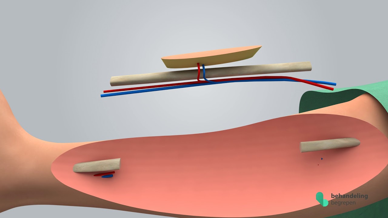Uitnemen kuitbeen VO ALT Final - YouTube