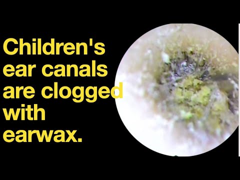 Children's ear canals are clogged with earwax.|ear wax removal | ear ...