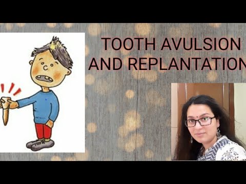 Tooth Avulsion and its treatment - YouTube