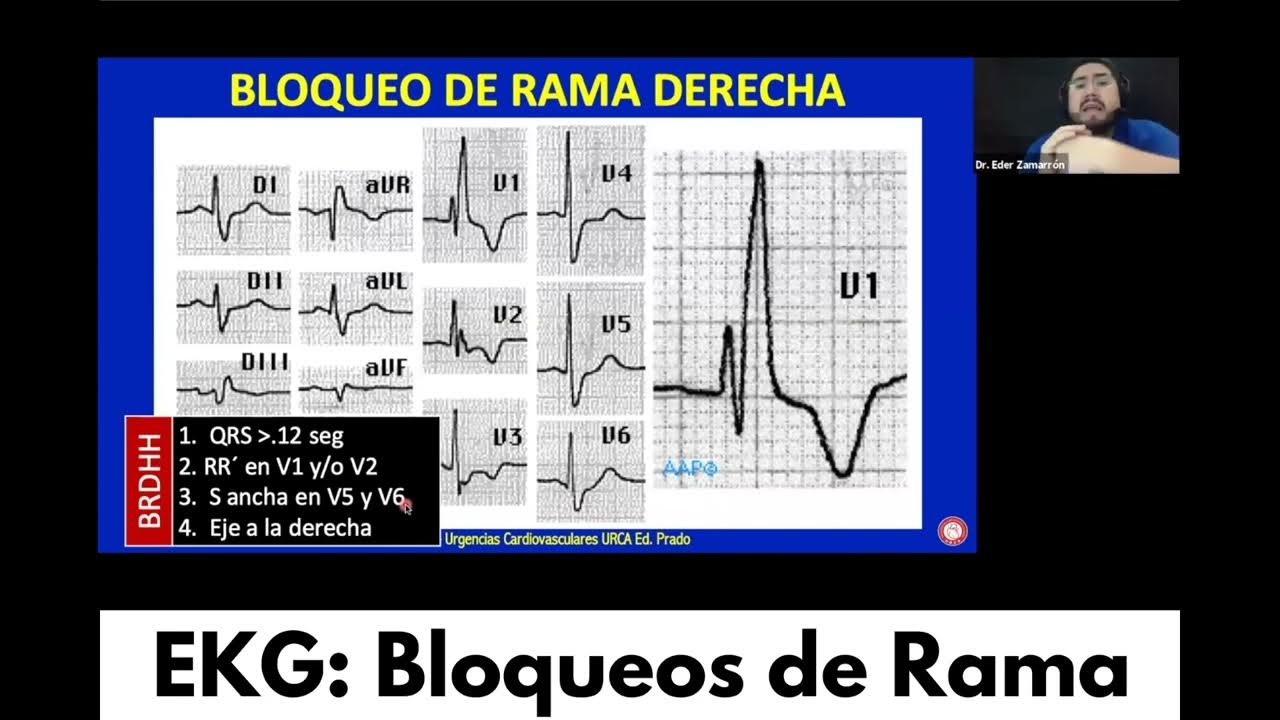 Bloqueo De Rama Derecha Bloqueo De Rama Derecha