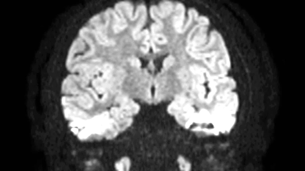 High resolution diffusion weighted imaging on 3 T brain MRI - YouTube