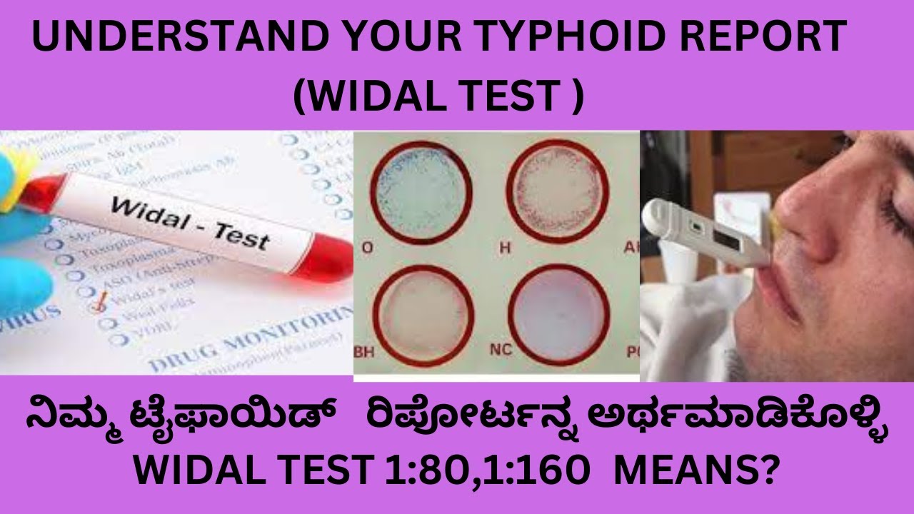 UNDERSTAND YOUR TYPHOID TEST(WIDAL TEST ) REPORT.POSITIVE/NEGETIVE ...