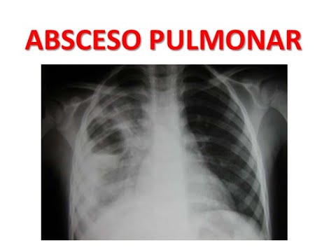 Diagnostico y tratamiento del Absceso Pulmonar (MEDICINA INTERNA) - YouTube