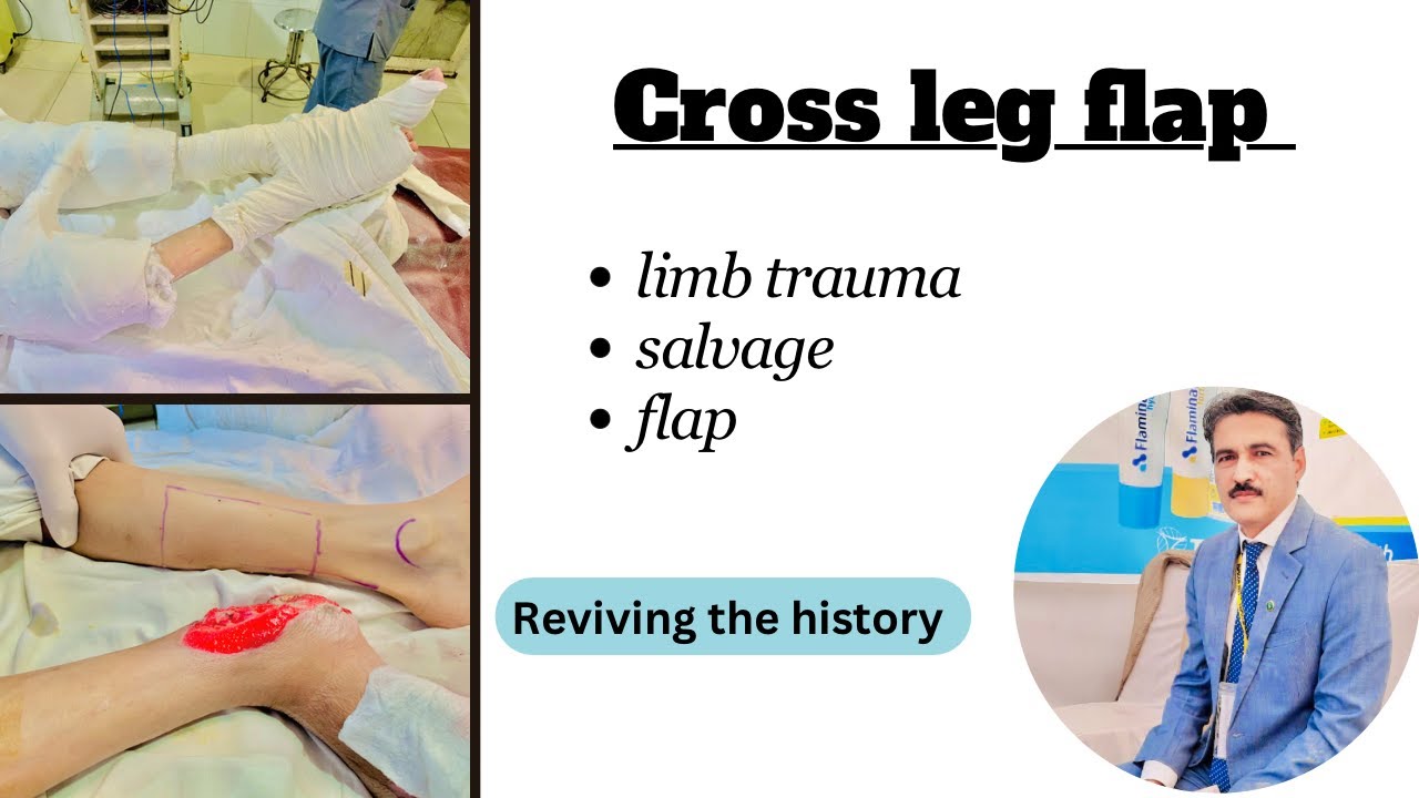 Flap# skin graft# Trauma# Limb Salvage # Cross leg flap# Reviving ...