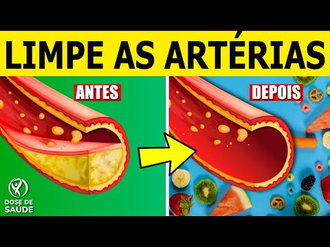 Estes 7 alimentos LIMPAM suas artérias e podem prevenir um ataque cardíaco (desobstrua as artérias)
