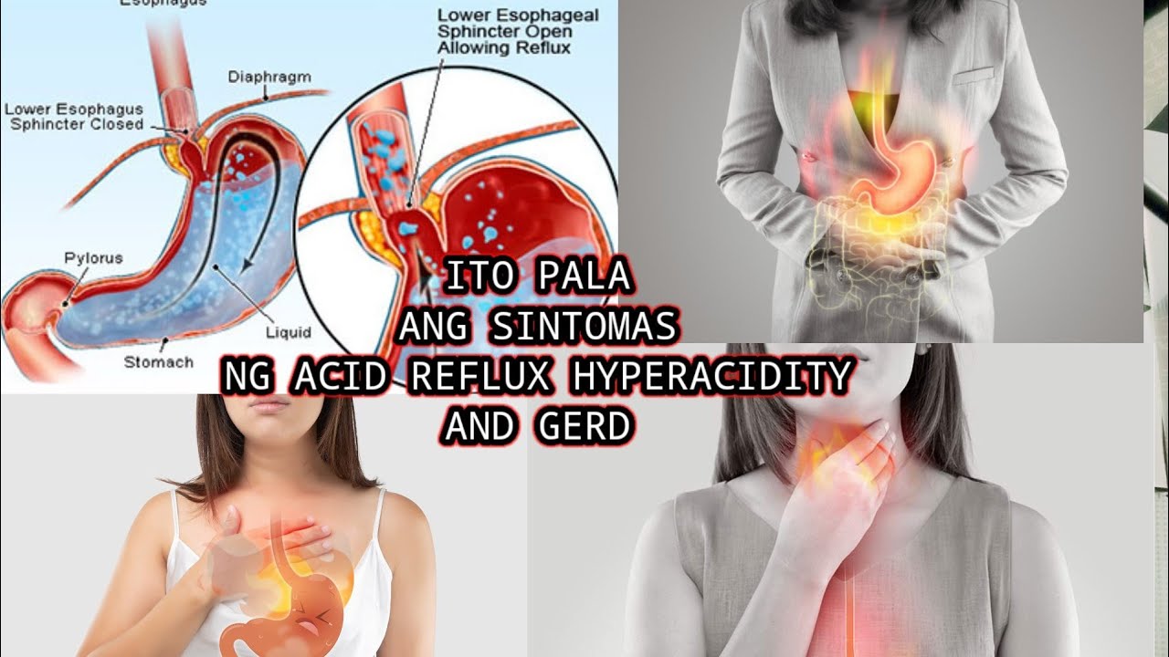 Ano Ang Acid reflux Hyperacidity And Gerd #acidity #gerd #hyperacidity ...