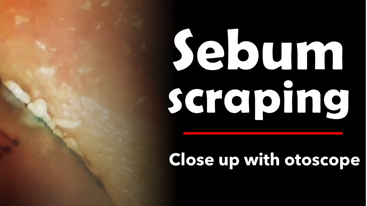 Squeezing sebum from nose and ears - extraction #10 - YouTube