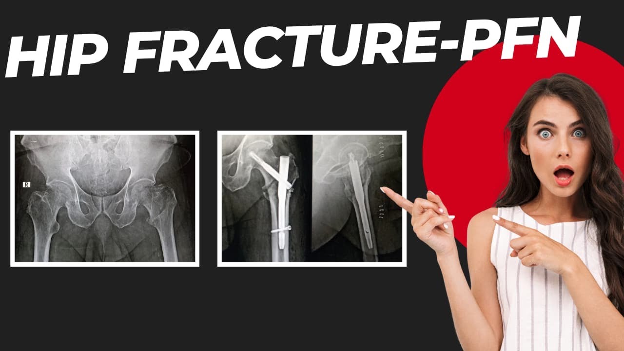 PFN FIXATION FOR HIP FRACTURE WITH MEDTRONICS SHORT PFN & MOBILISED ...