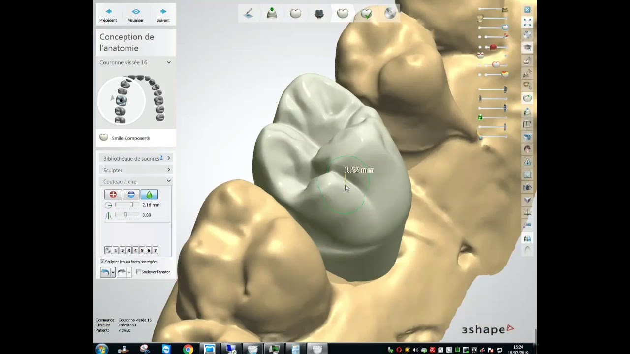 Couronne transvissé 3shape - YouTube