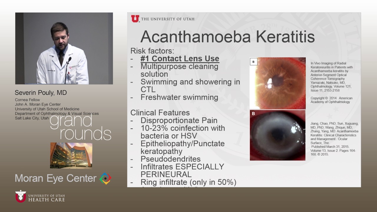 Acanthamoeba Keratitis Ring Infiltrate