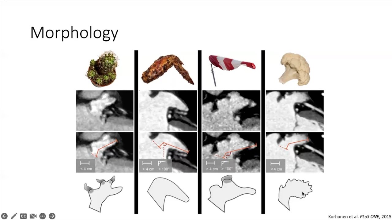 Chicken Wing, Cactus, Windsock: Review of LAA Pathophysiology and ...