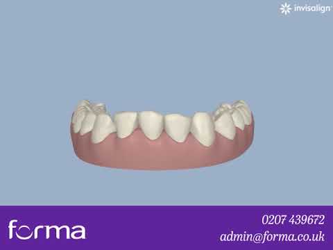 Forma Dental Invisalign Treatment time-lapse 07 - YouTube