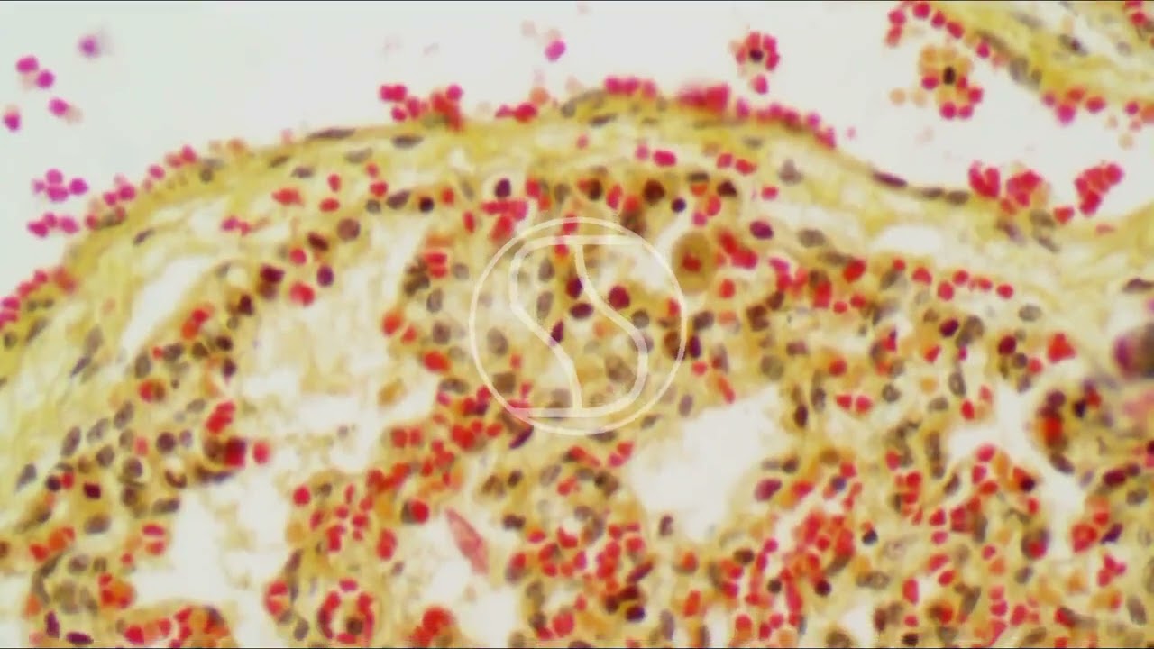 Cytomegalovirus under the microscope with Phloxine Tartrazine stain ...