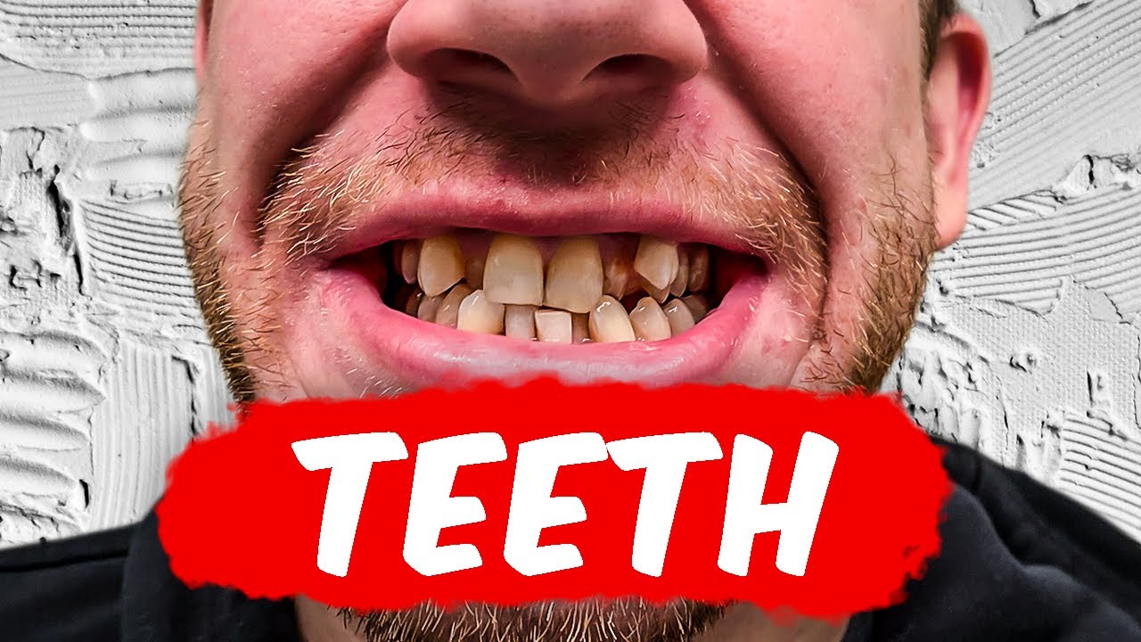 Teeth: My Amazing Braces Transformation - YouTube