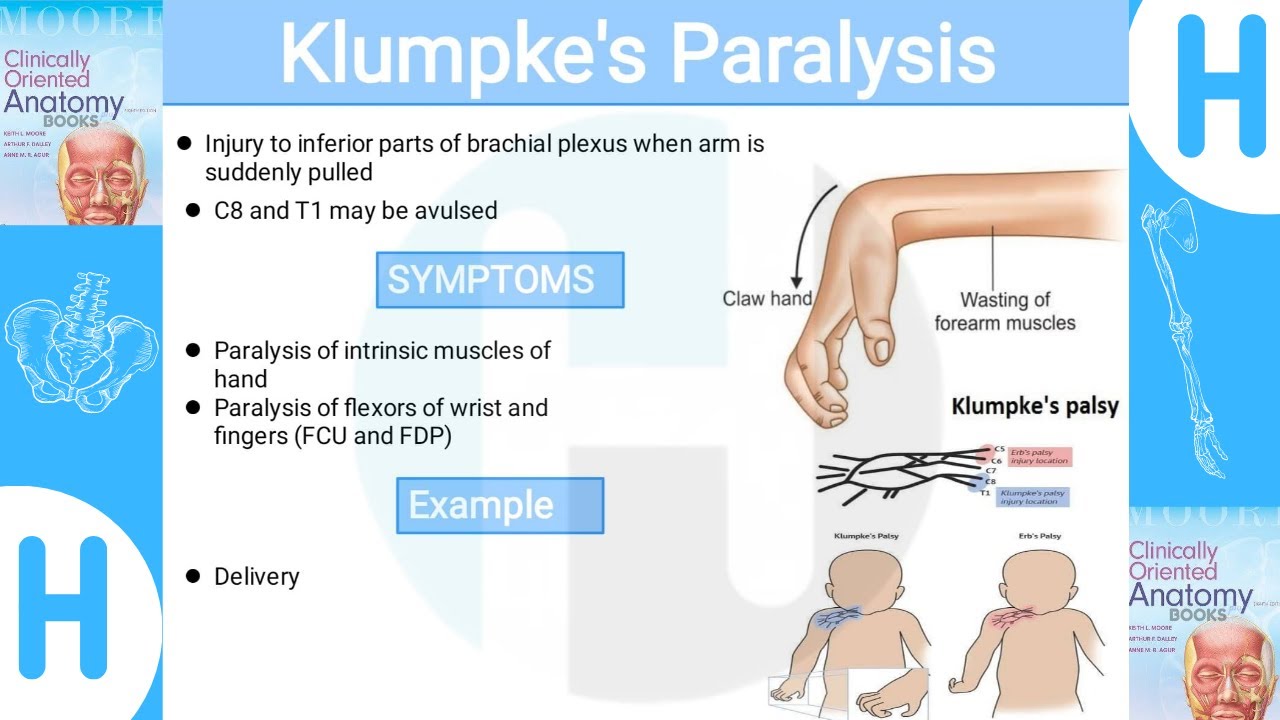 Klumpke's Paralysis:Upper Limb Clinicals - Brief Explanation - YouTube