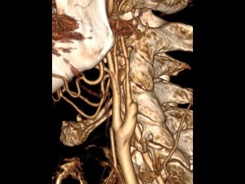 Case of internal carotid artery dissection MRI, CTA and Duplex Scanning ...