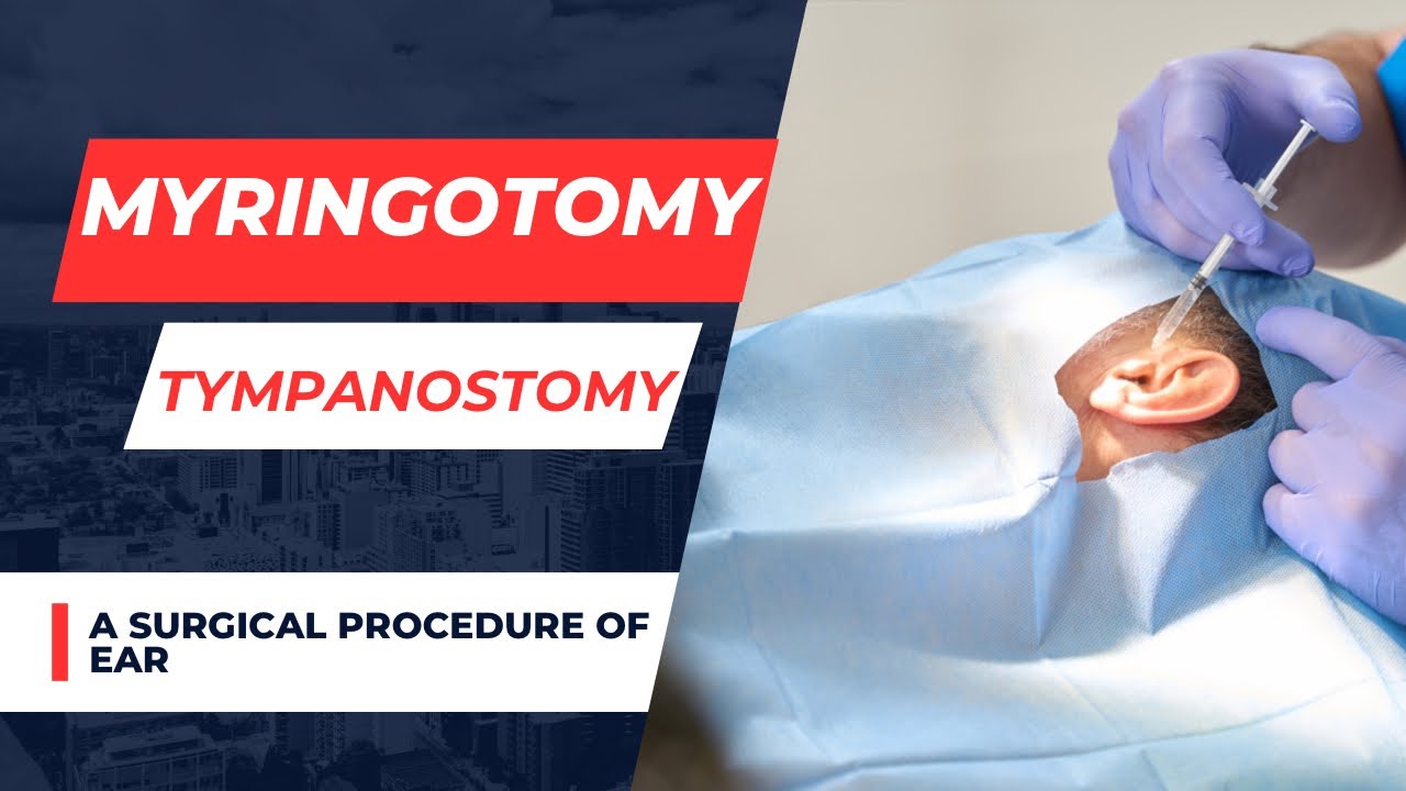 Myringotomy (Tympanostomy ) : A Comprehensive Guide to the Surgical ...