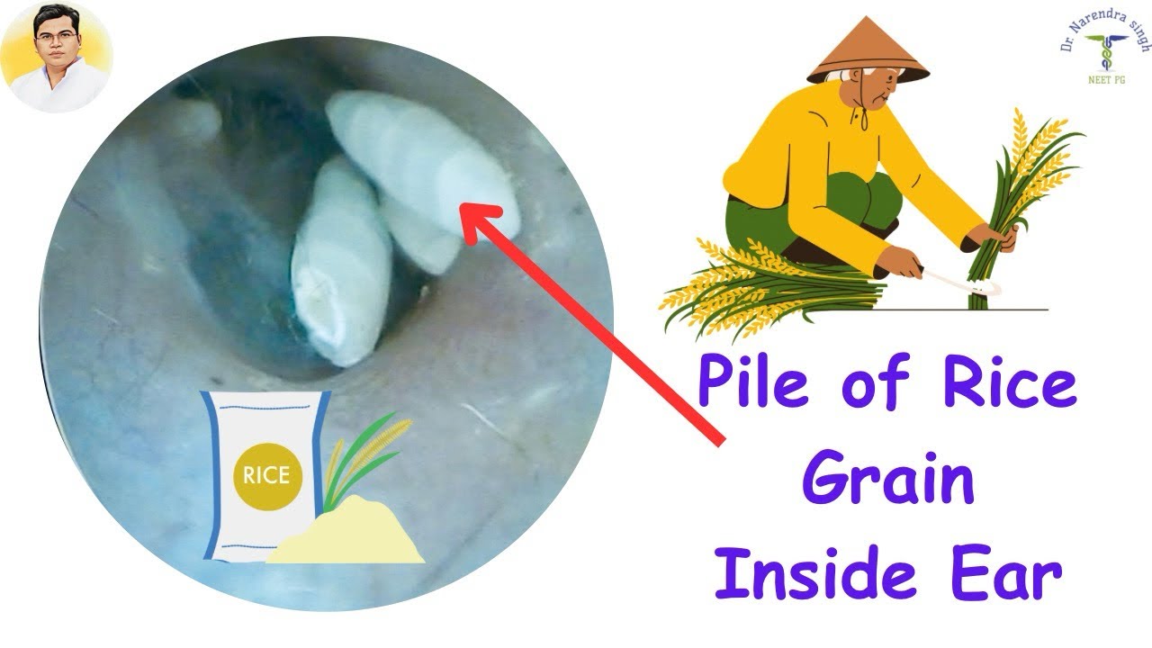 PILE OF RICE GRAIN INSIDE EAR 👂 - YouTube