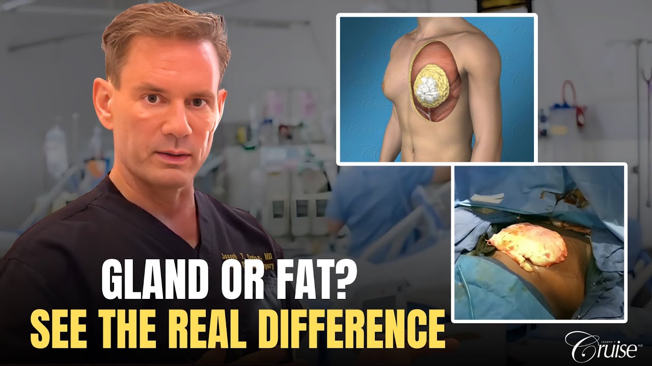 Gynecomastia Gland Removal Surgery - YouTube