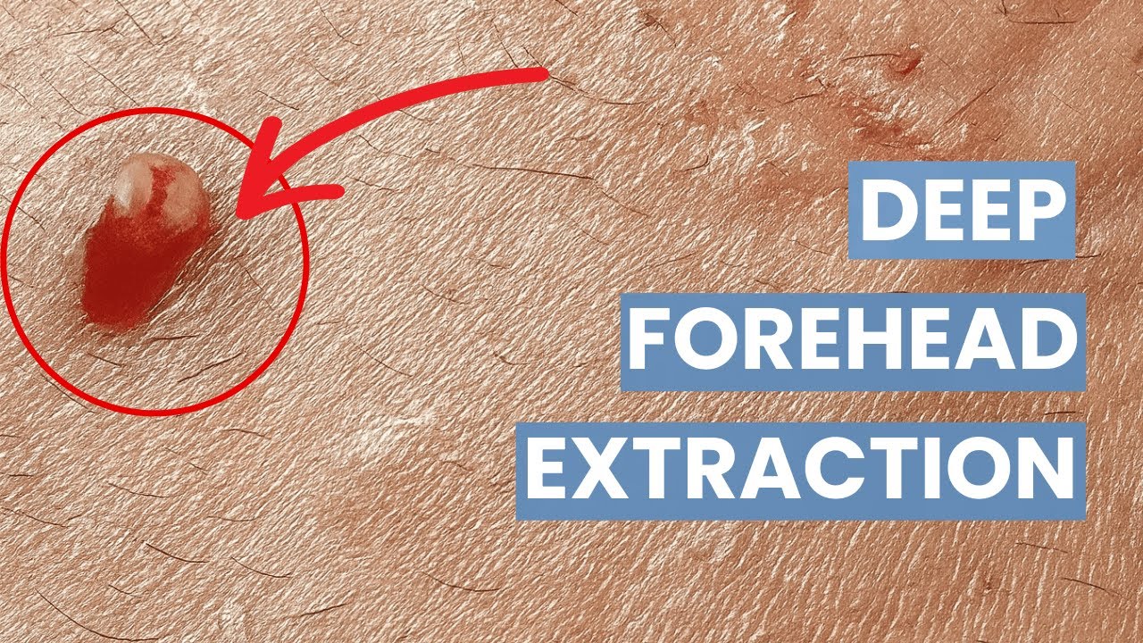 Hidden Deep Blackheads EXPLODE with Pus – Satisfying Forehead acne ...