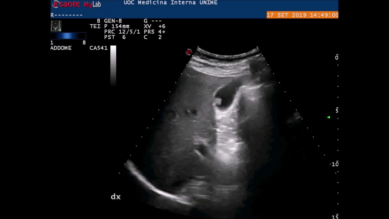 Ultrasound Gallbladder stone and polyp - YouTube