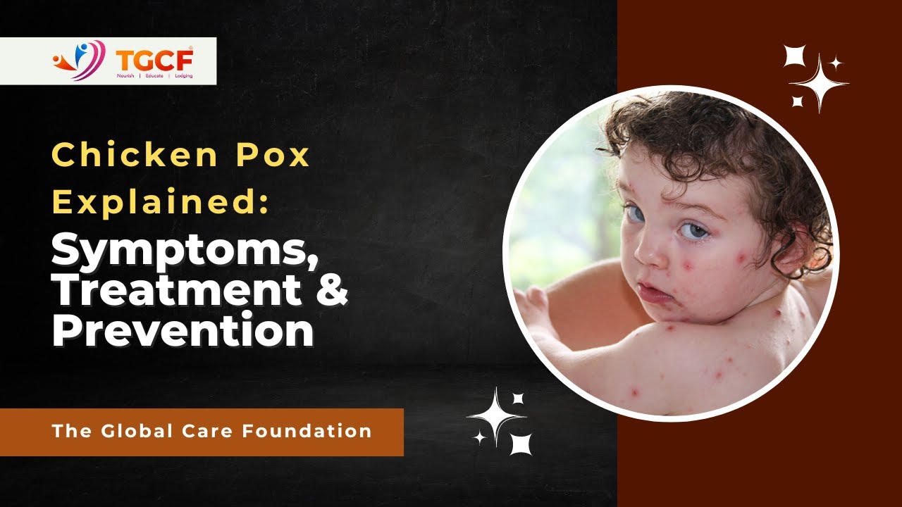 Understanding Chickenpox: Symptoms, Treatment, and Prevention # ...