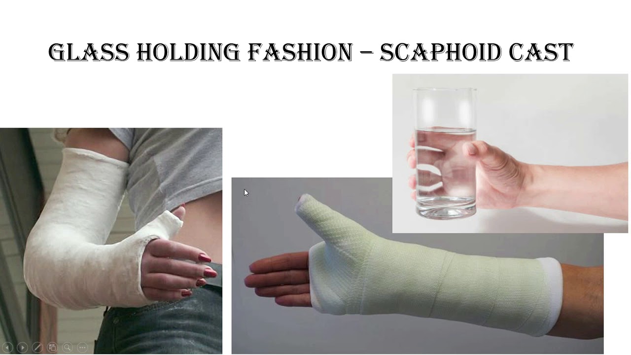 Sacphoid Facture - YouTube