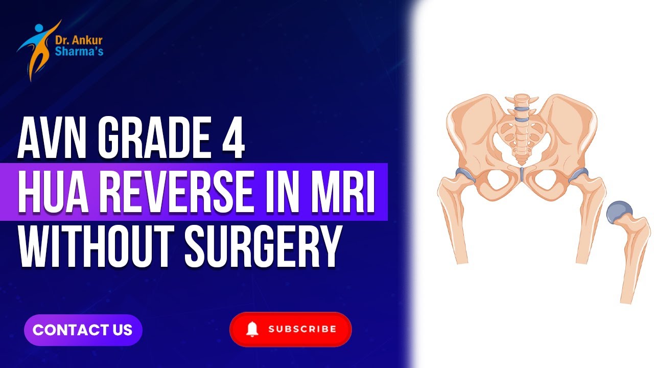 Avn grade 4 successfully treated with extracorporeal shockwave therapy ...