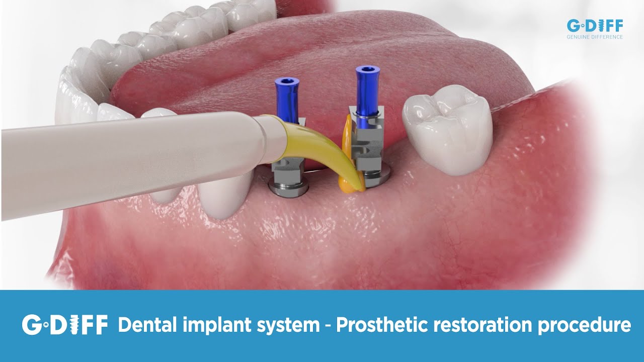 GDIFF Dental implant system - Prosthetic restoration procedure - YouTube