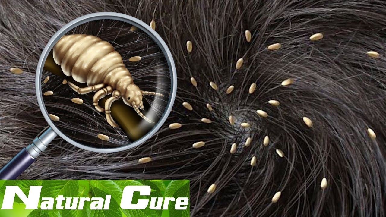 Natural Cure How To Get Rid Of Lice Permanently 9 Home Remedies For