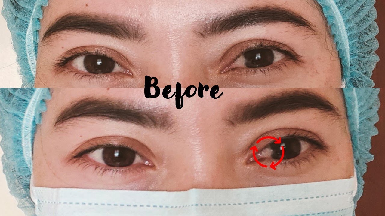 pterygium-removal-surgery-pugita-sa-mata-binggaysofficialvlog-youtube