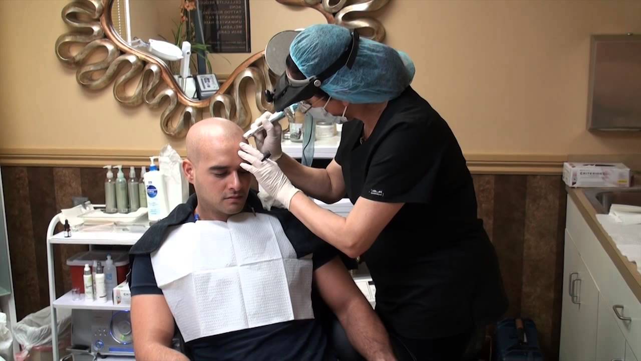 Scalp Medical Micropigmentation - YouTube