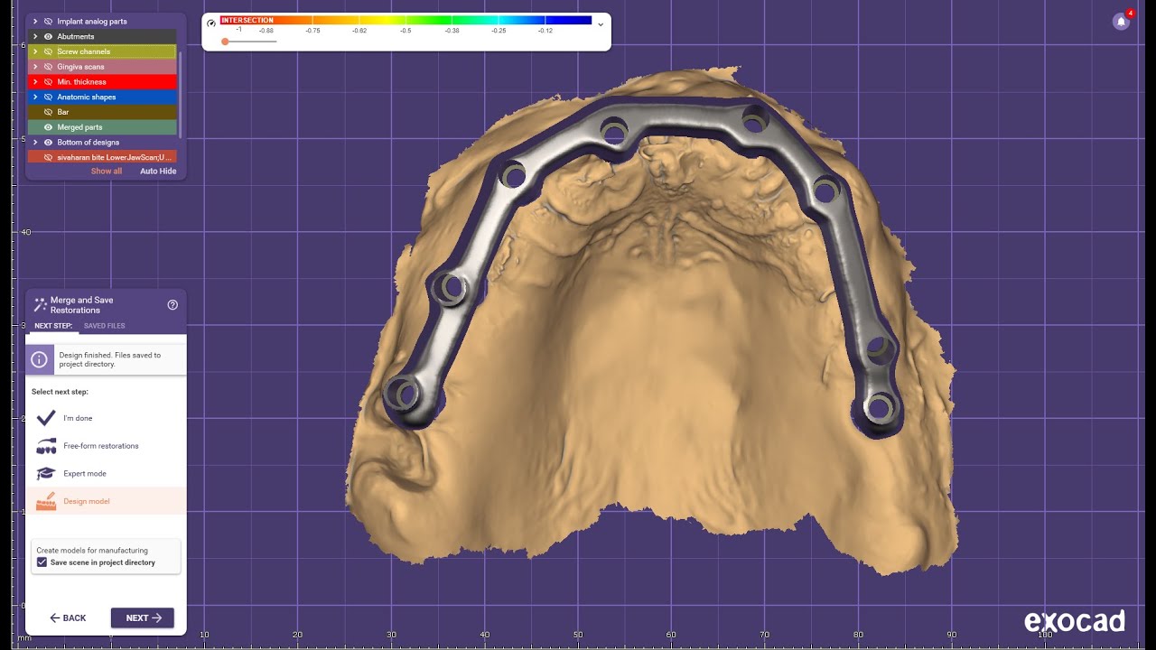 Exocad designing for Upper titanium bar - screw retained implant with ...